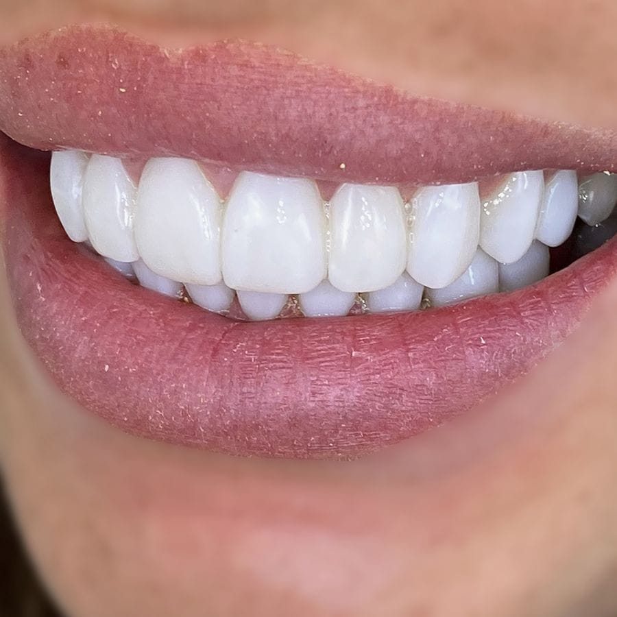Revealing the Intricate Process of Composite Bonding - Abacus Dental ...